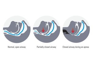 Obstructive vs Central Sleep Apnea differences | Resmed
